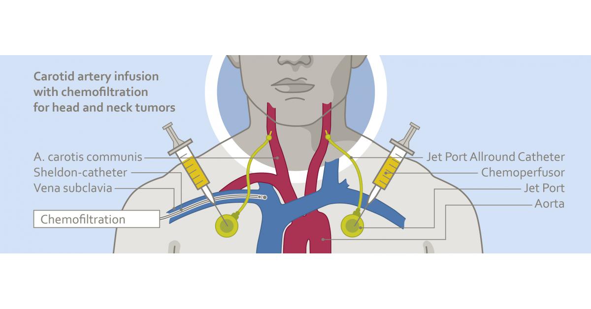 Improved tumor control and quality of life: Results of a new treatment ...