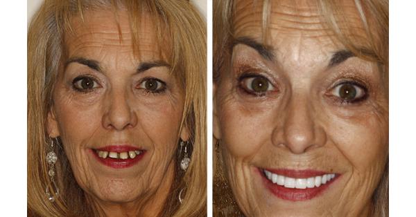 Dr. Frank Roach Provides “All-on-Four” procedure to Give Patients a ...