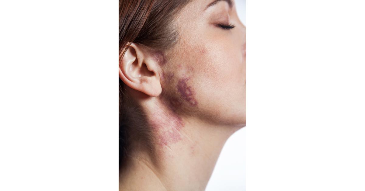 New Hope for Port Wine Stain Patients from a Novel Image-Guided Treatment